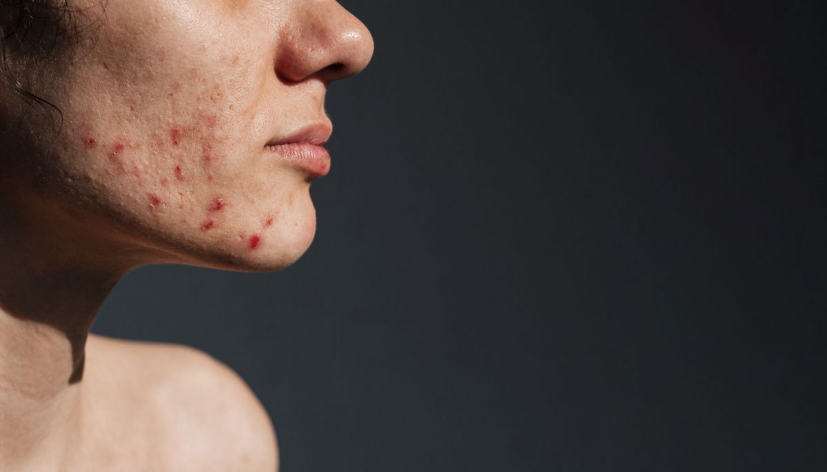 Leistungsstarkes neues Medikament gegen Akne in Sicht | aponet.de
