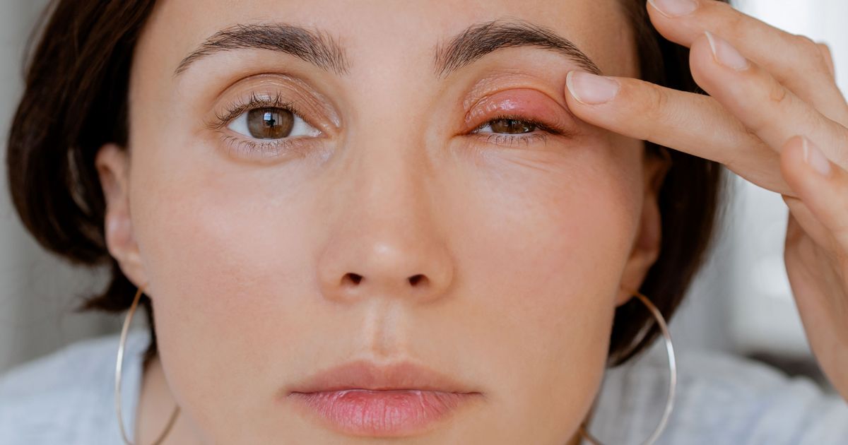 Gerstenkorn: Symptome, Behandlung & Tipps | aponet.de