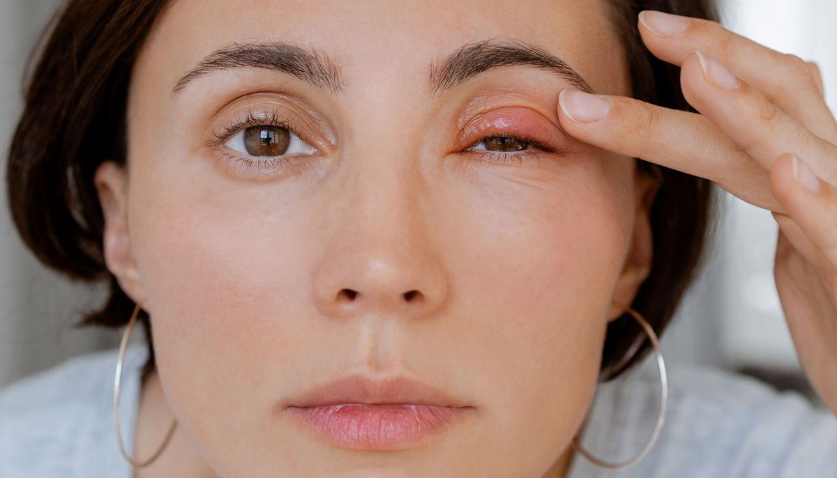 Gerstenkorn: Symptome, Behandlung & Tipps | aponet.de