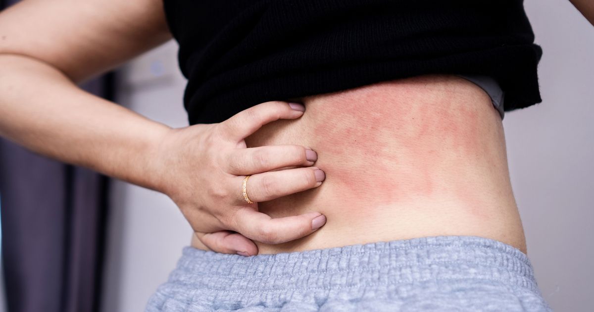 Nesselsucht: Symptome, Behandlung und Tipps | aponet.de
