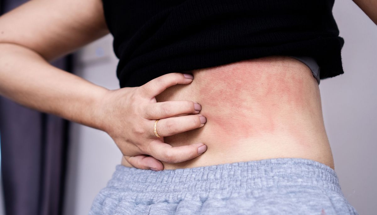 Nesselsucht: Symptome, Behandlung und Tipps | aponet.de